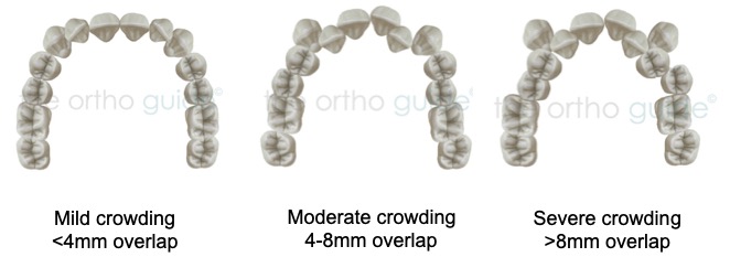 Crowding The Ortho Guide